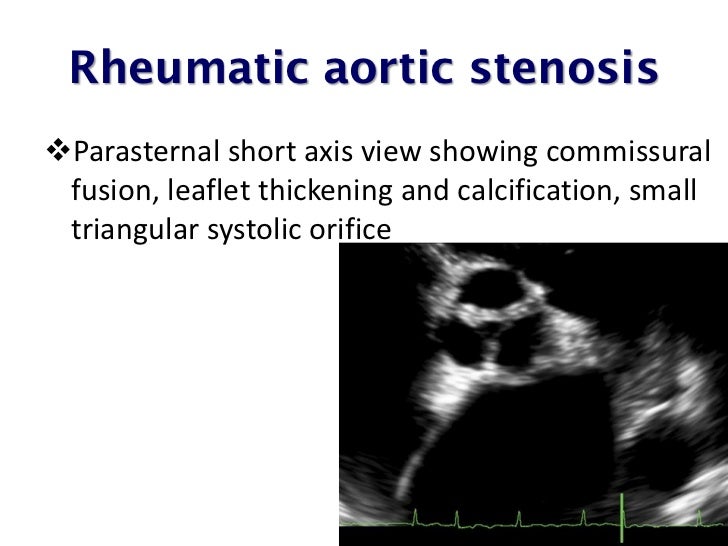 Echo assessment of Aortic Stenosis
