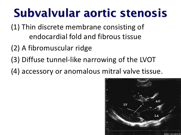 Echo assessment of Aortic Stenosis