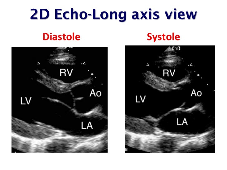Echo assessment of Aortic Stenosis