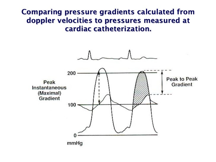 Echo assessment of Aortic Stenosis