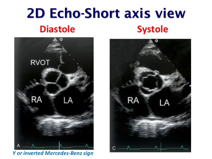 Echo assessment of Aortic Stenosis