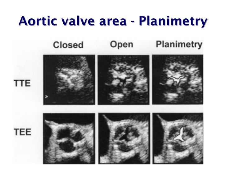 Echo assessment of Aortic Stenosis