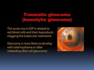 Acute Rise in IOP (Dr. Rasha, senior resident of ophthalmology) | PPTX
