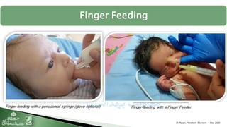 Dr ravari finger feeding, dropper, spoon, syringe and bottle feeding | PDF