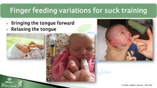 Dr ravari finger feeding, dropper, spoon, syringe and bottle feeding | PDF