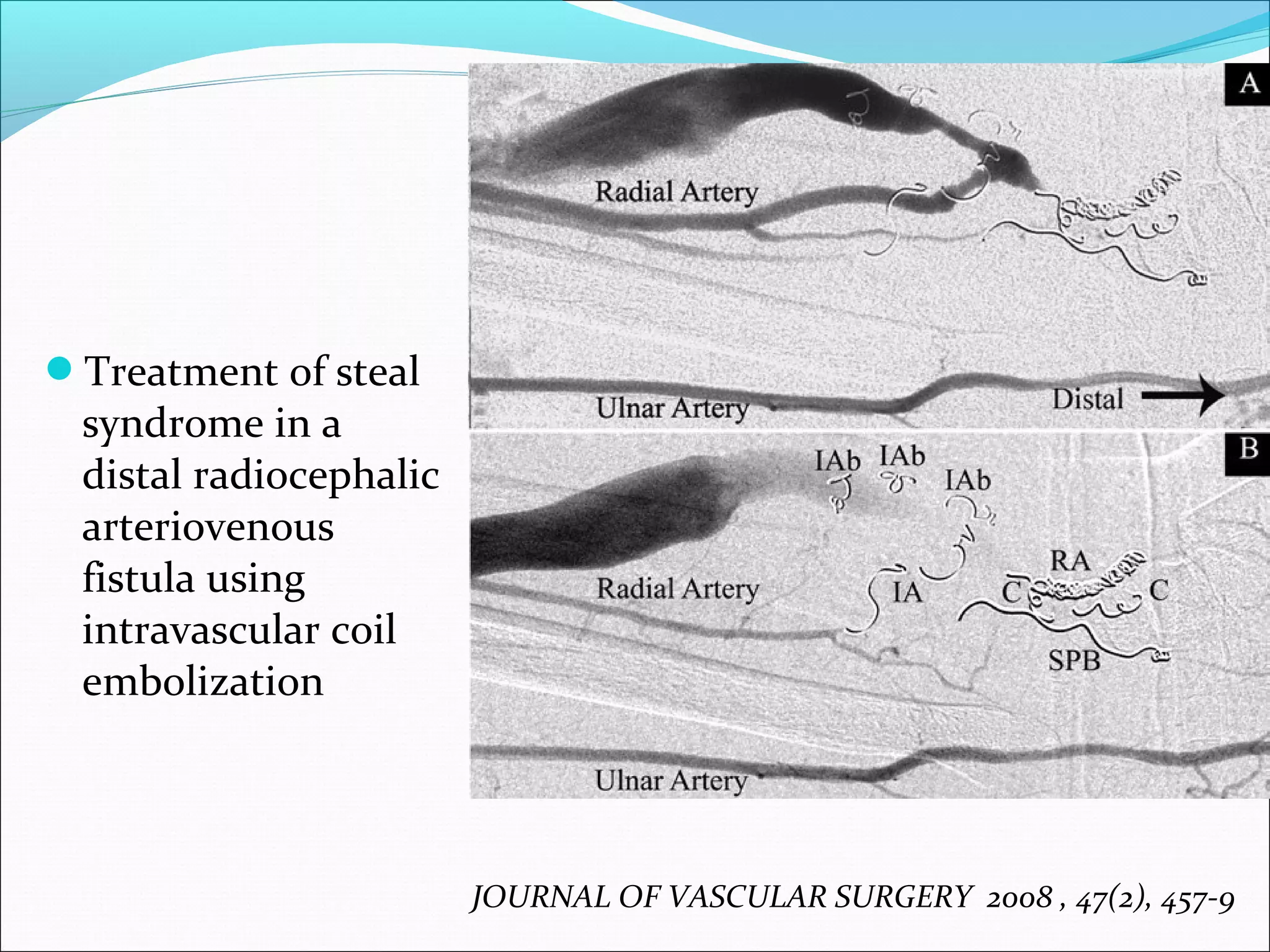 Management of steal syndrome || Dr Ravi Bansal | PPT