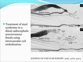 Management of steal syndrome || Dr Ravi Bansal | PPT