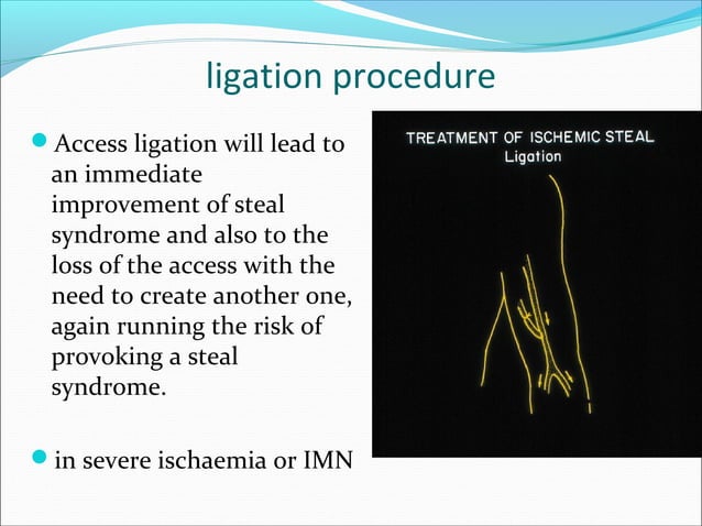 Management Of Steal Syndrome Dr Ravi Bansal Ppt