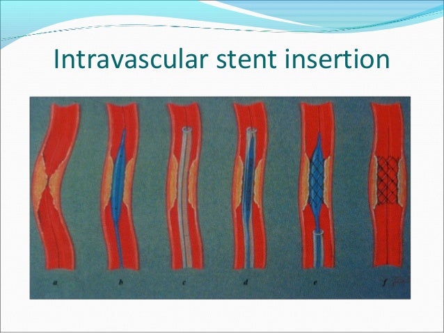 Management of steal syndrome || Dr Ravi Bansal