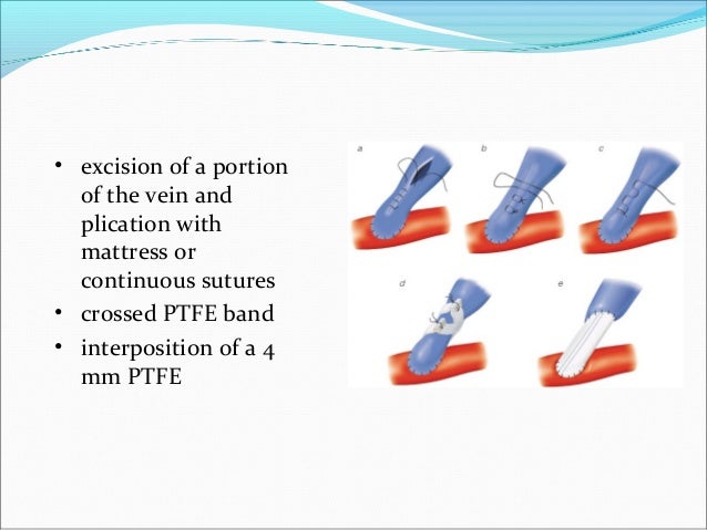 Management of steal syndrome || Dr Ravi Bansal