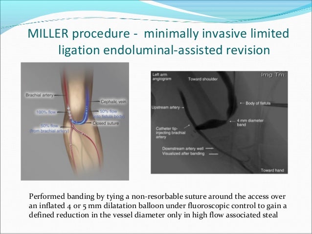 Management of steal syndrome || Dr Ravi Bansal