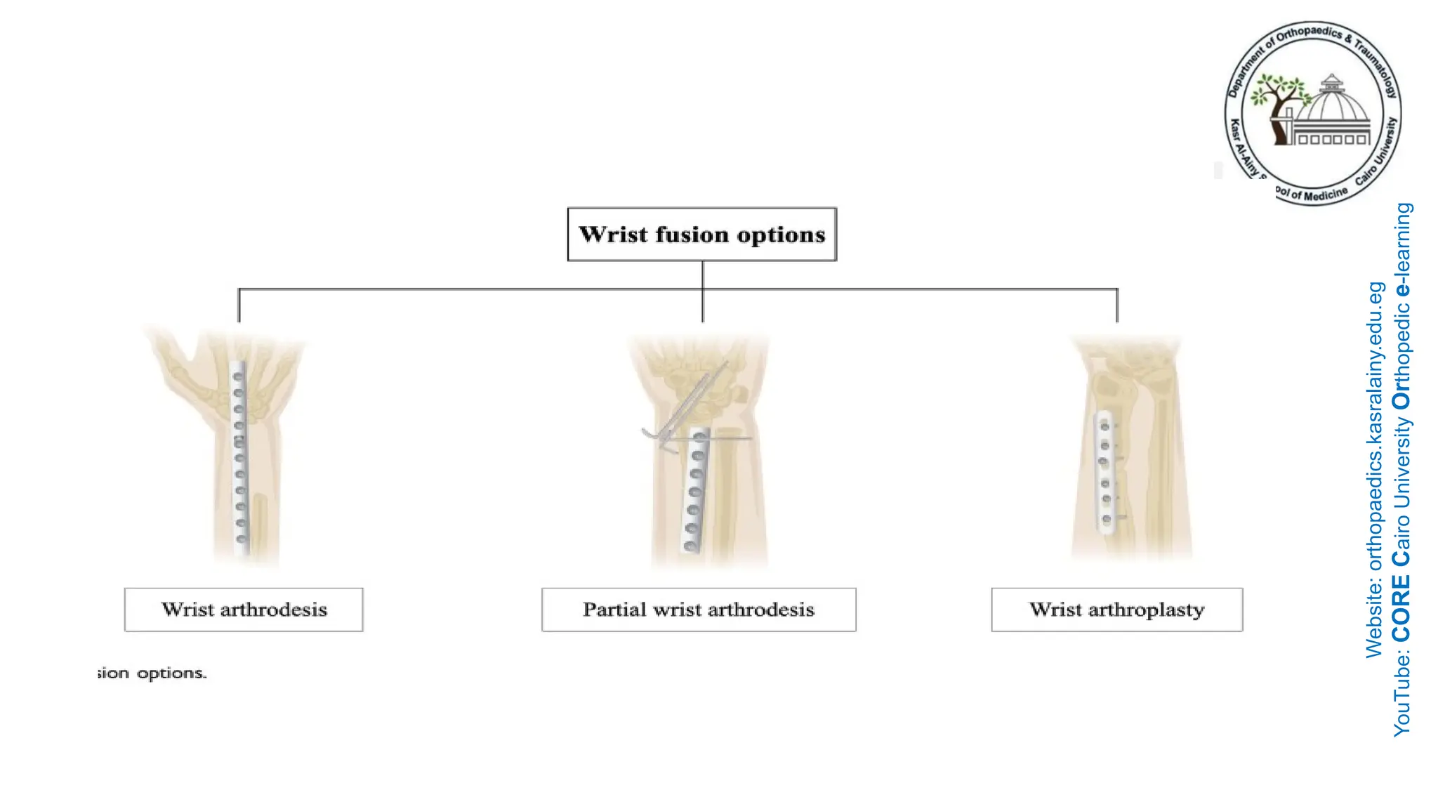 distal radius reconstruction technique ppt | PPTX