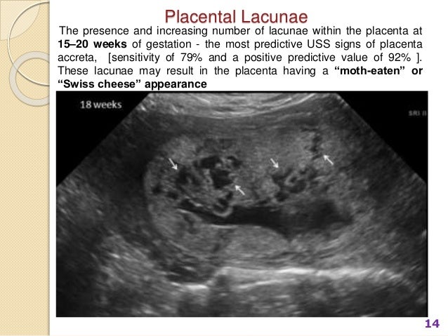 Morbidly Adherent Placenta Conservative Management