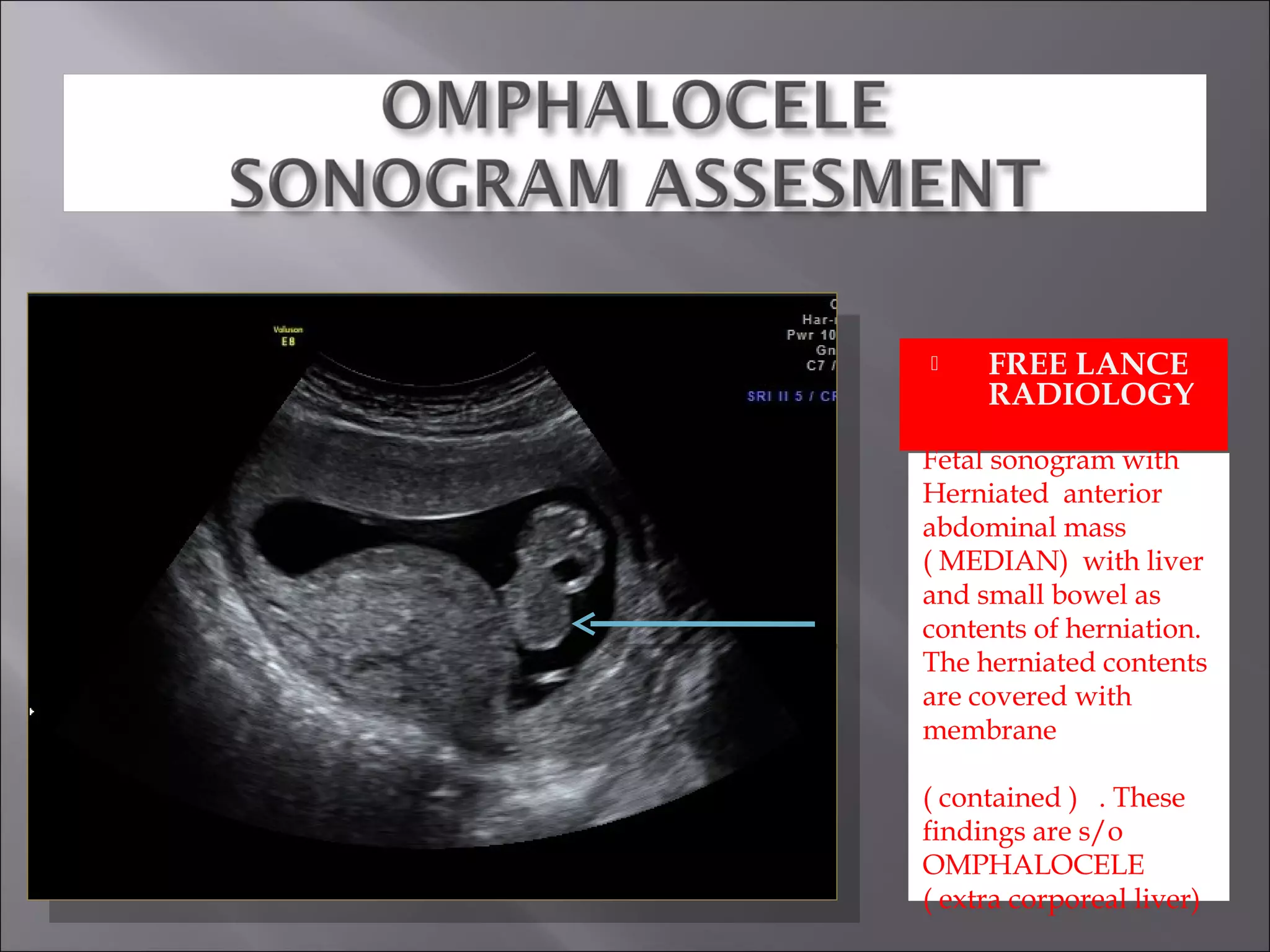 fetal imaging omphalocele | PPT