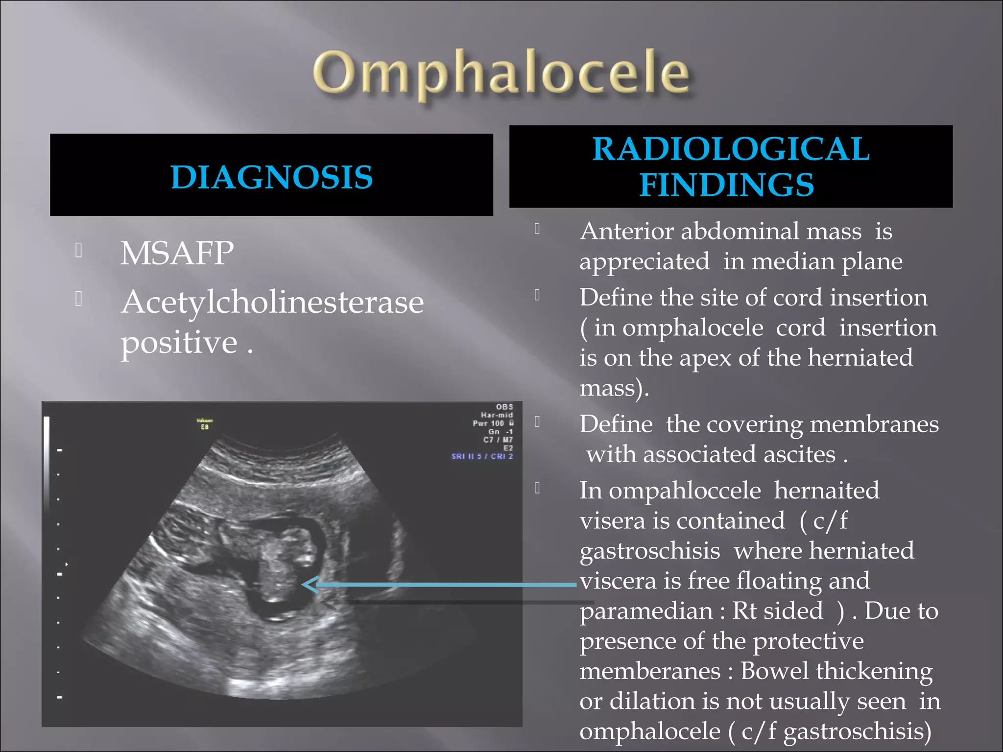 fetal imaging omphalocele | PPT