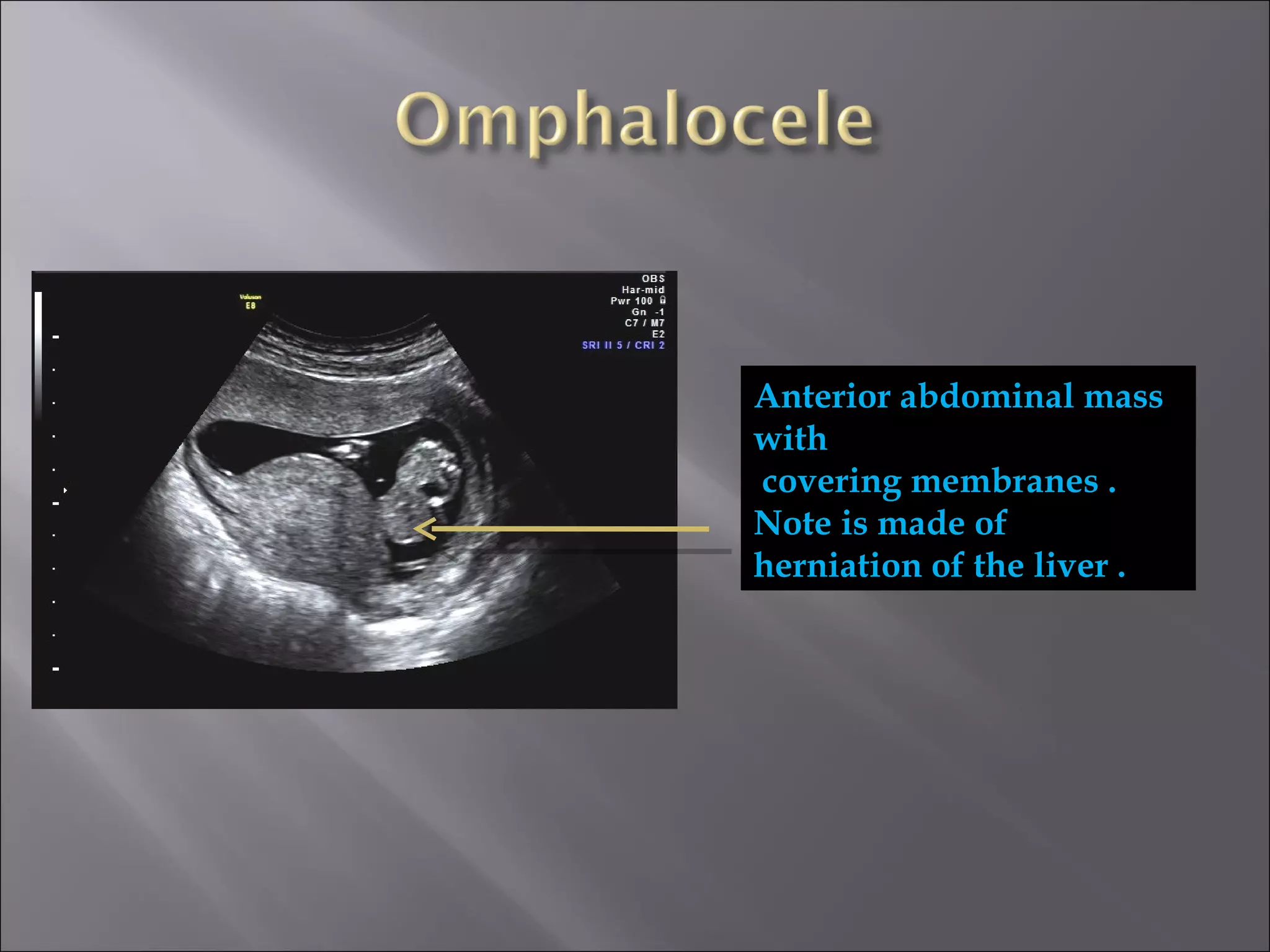 Fetal Imaging Omphalocele Ppt
