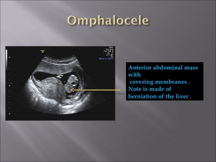 fetal imaging omphalocele