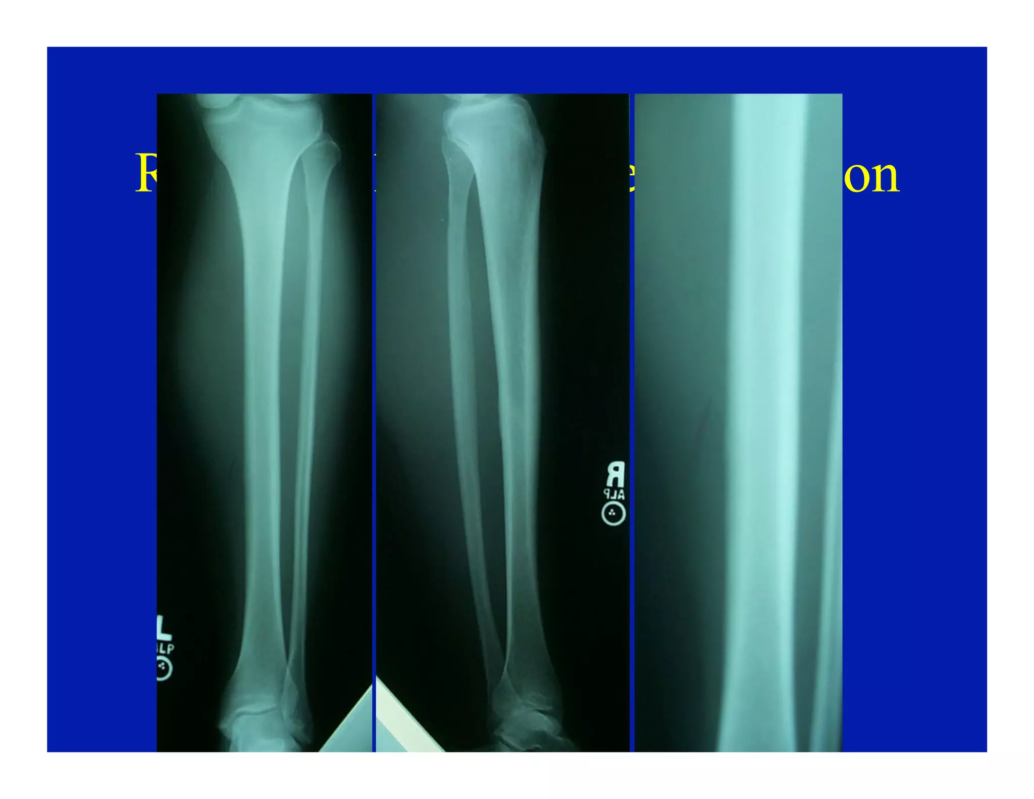 Bone Status and Navy Stress Fractures | PPT