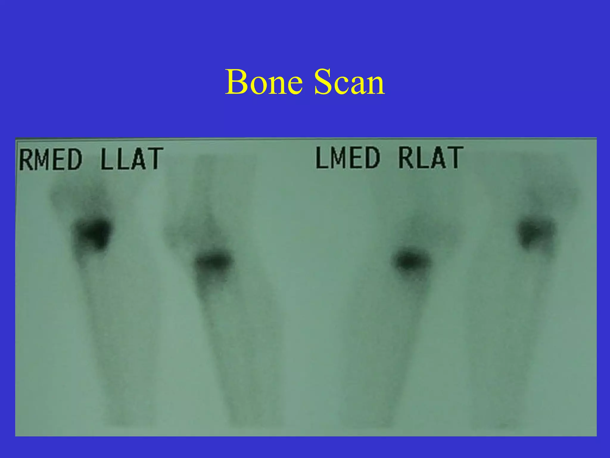 Osteopenia and stress fractures | PPT