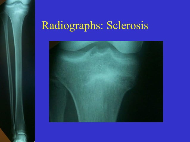 Osteopenia and stress fractures | PPT