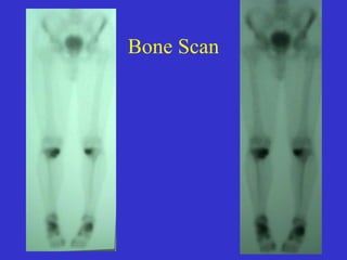 Osteopenia and stress fractures | PPT