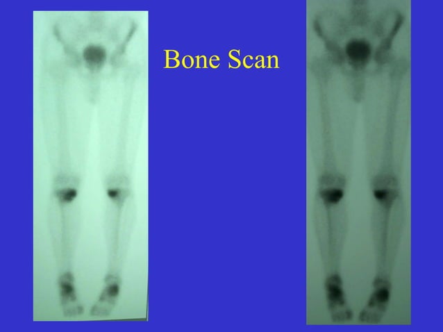 Osteopenia and stress fractures | PPT