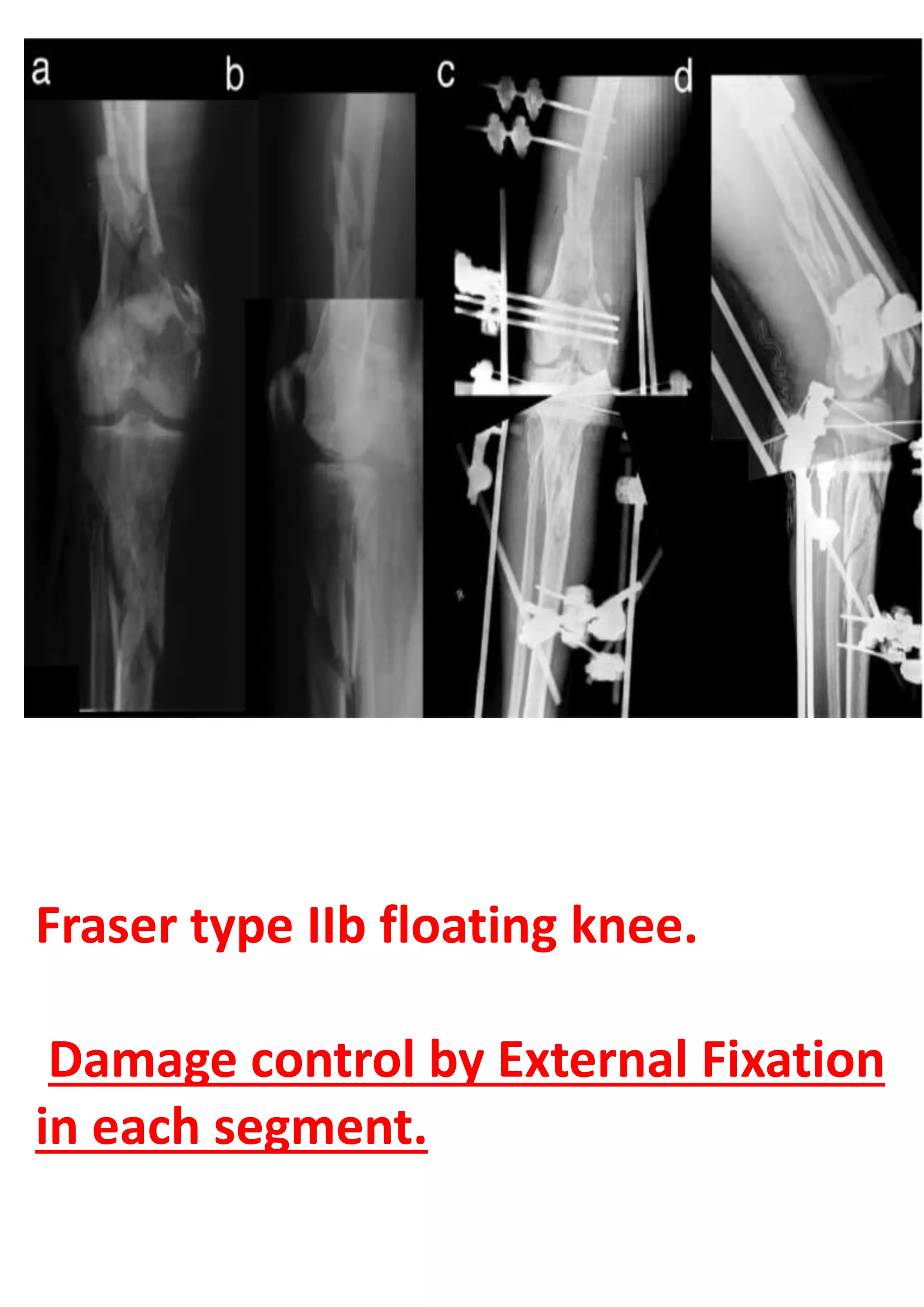 Floating Knee | PPTX