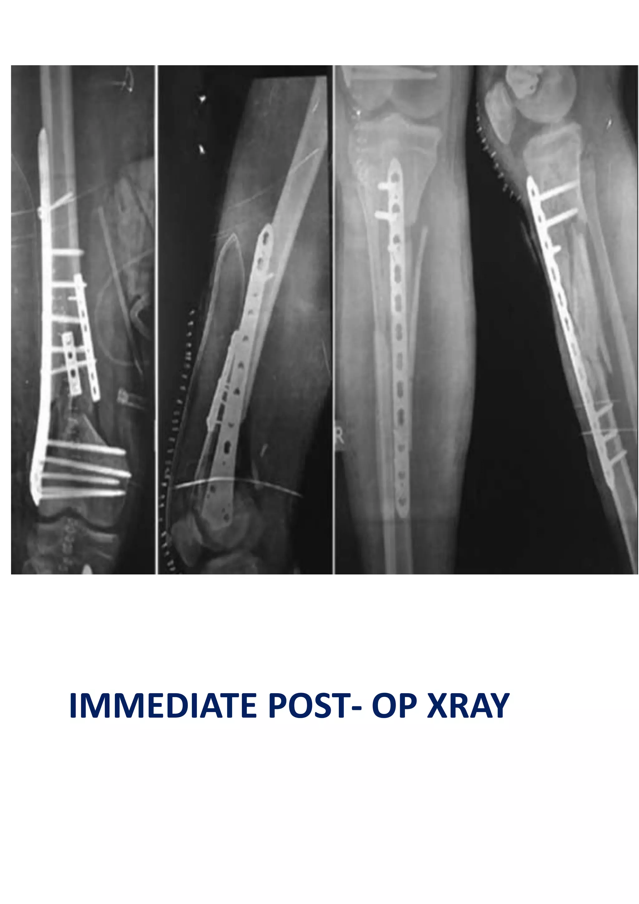 Floating Knee | PPTX | First Aid | Injuries