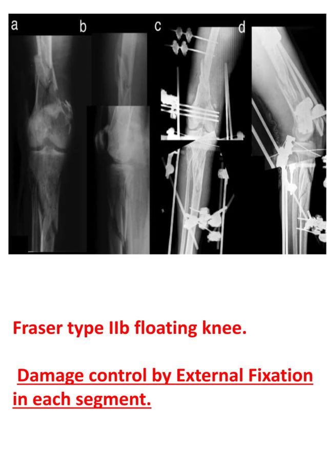 Floating Knee | PPTX | First Aid | Injuries