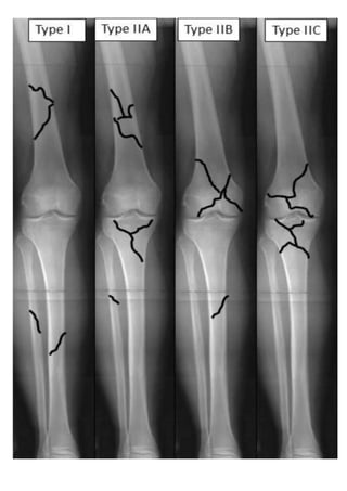 Floating Knee | PPTX | First Aid | Injuries