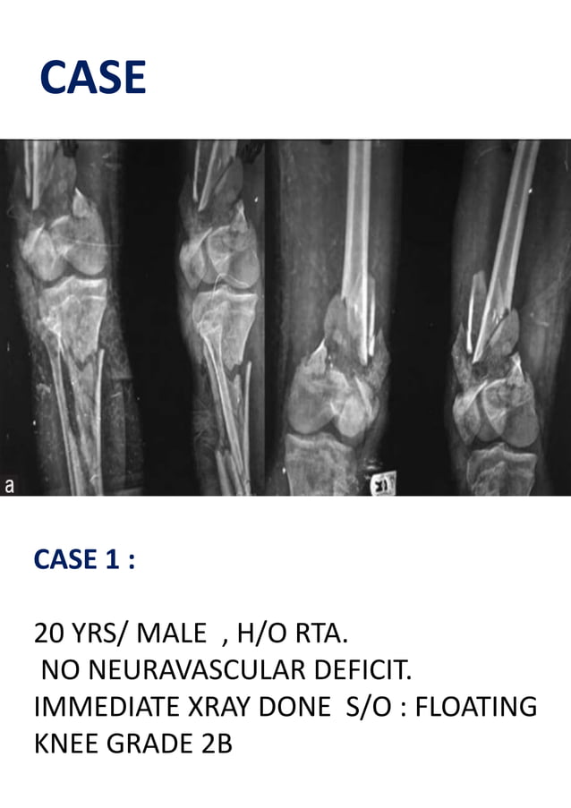 Floating Knee | PPTX | First Aid | Injuries