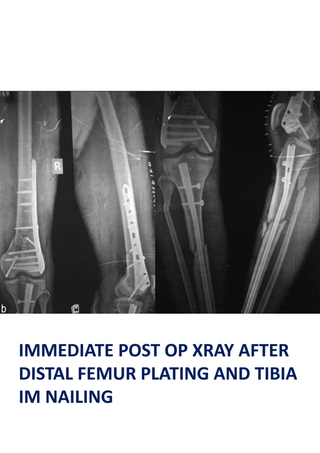 Floating Knee | PPTX | First Aid | Injuries
