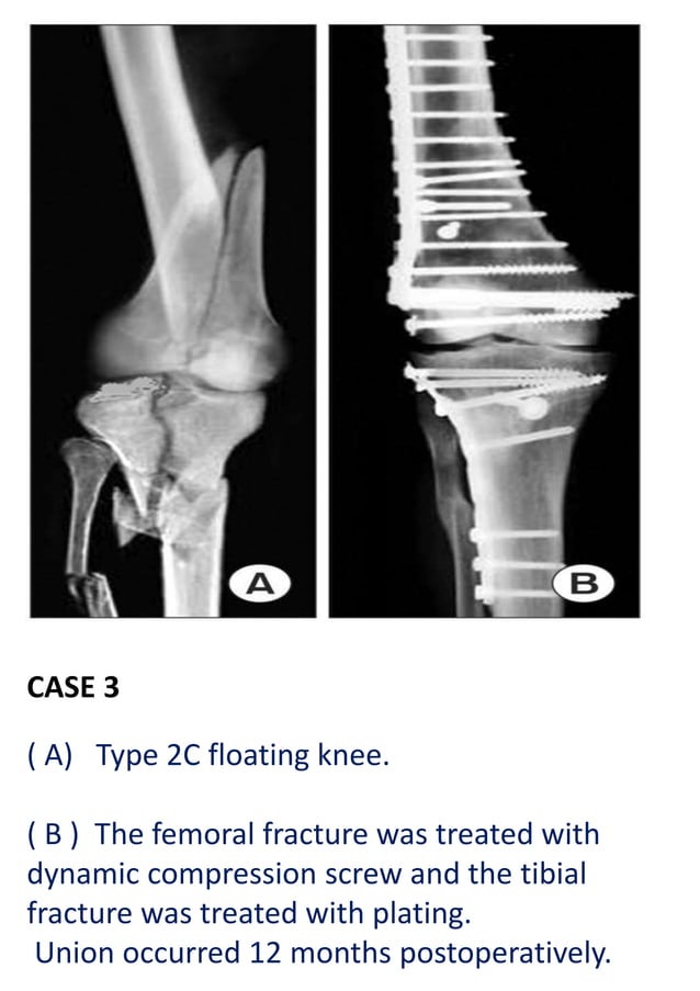 Floating Knee | PPTX | First Aid | Injuries