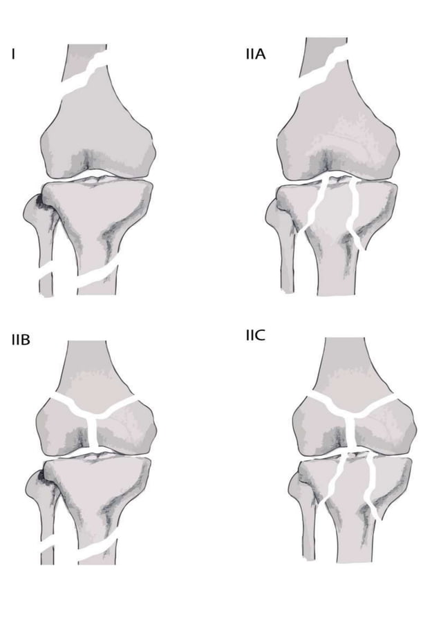 Floating Knee | PPTX | First Aid | Injuries