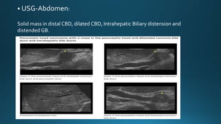 Pancreatic Cancer ( Malignant Obstructive Jaundice ) | PPTX