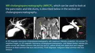 Pancreatic Cancer ( Malignant Obstructive Jaundice ) | PPTX