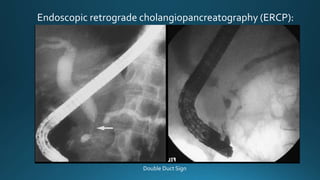 Pancreatic Cancer ( Malignant Obstructive Jaundice ) | PPTX