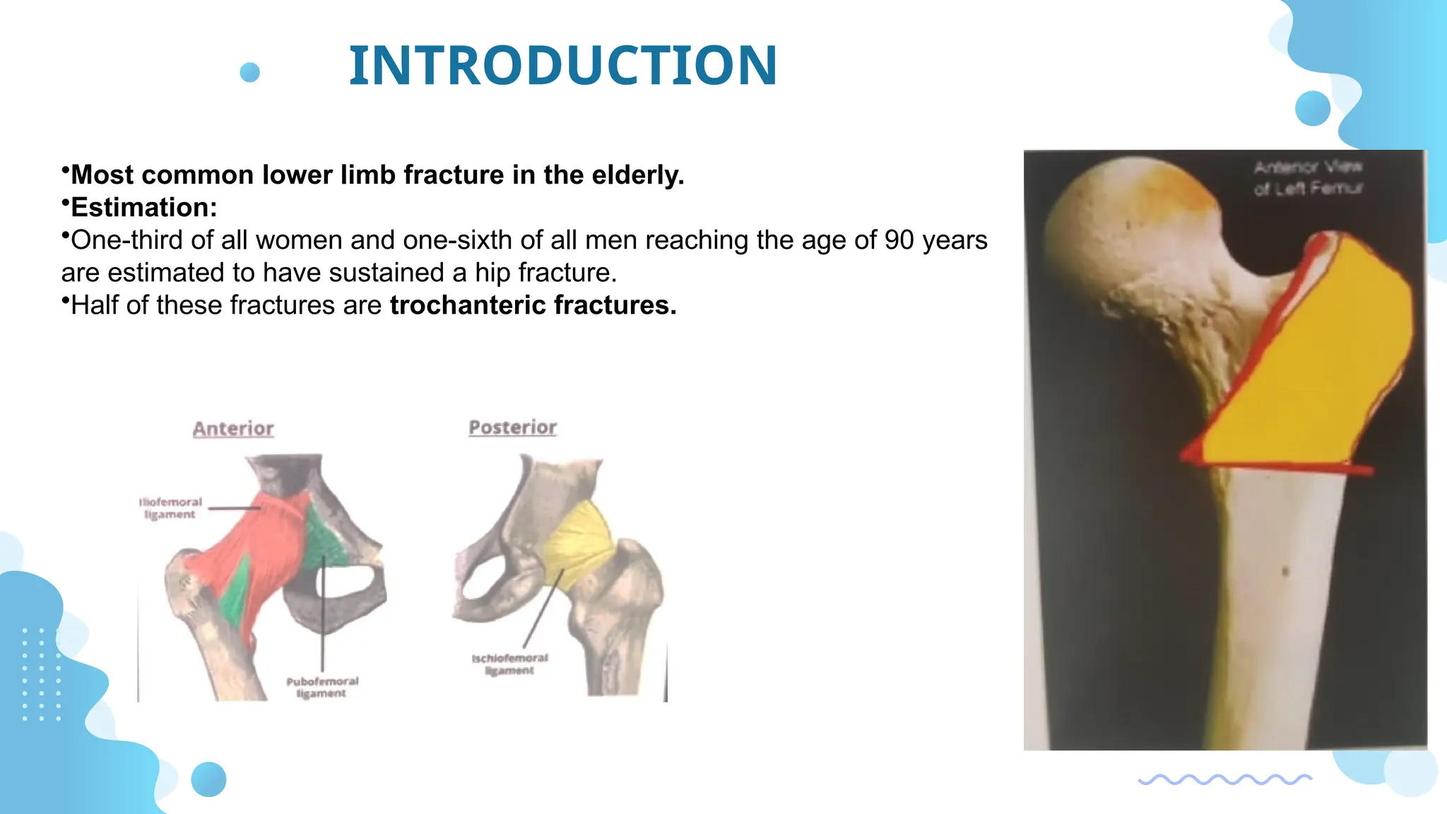 Unstable Trochanteric Fractures: The Role of Lateral Wall ...