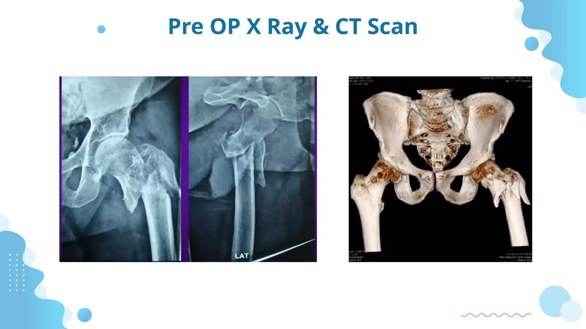 Unstable Trochanteric Fractures: The Role of Lateral Wall ...