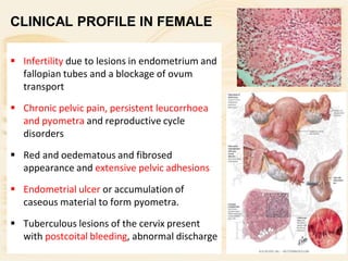 REPRODUCTIVE TRACT INFECTIONS DUE TO MTB | PDF