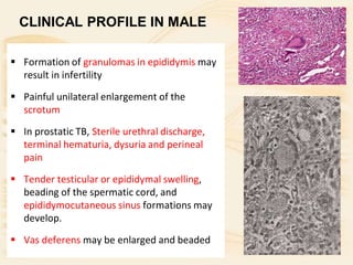 REPRODUCTIVE TRACT INFECTIONS DUE TO MTB | PDF