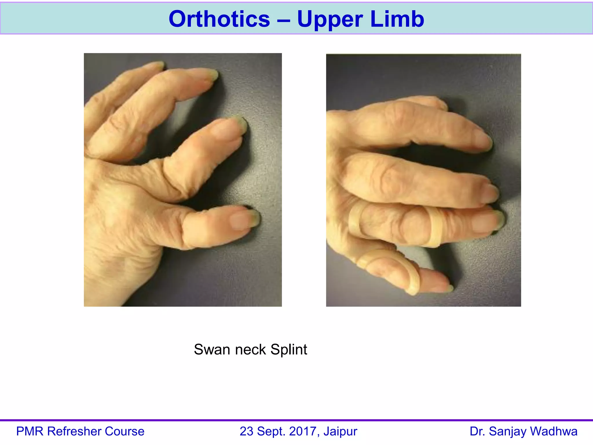 Upper Limb Orthotics - Dr Sanjay Wadhwa | PDF