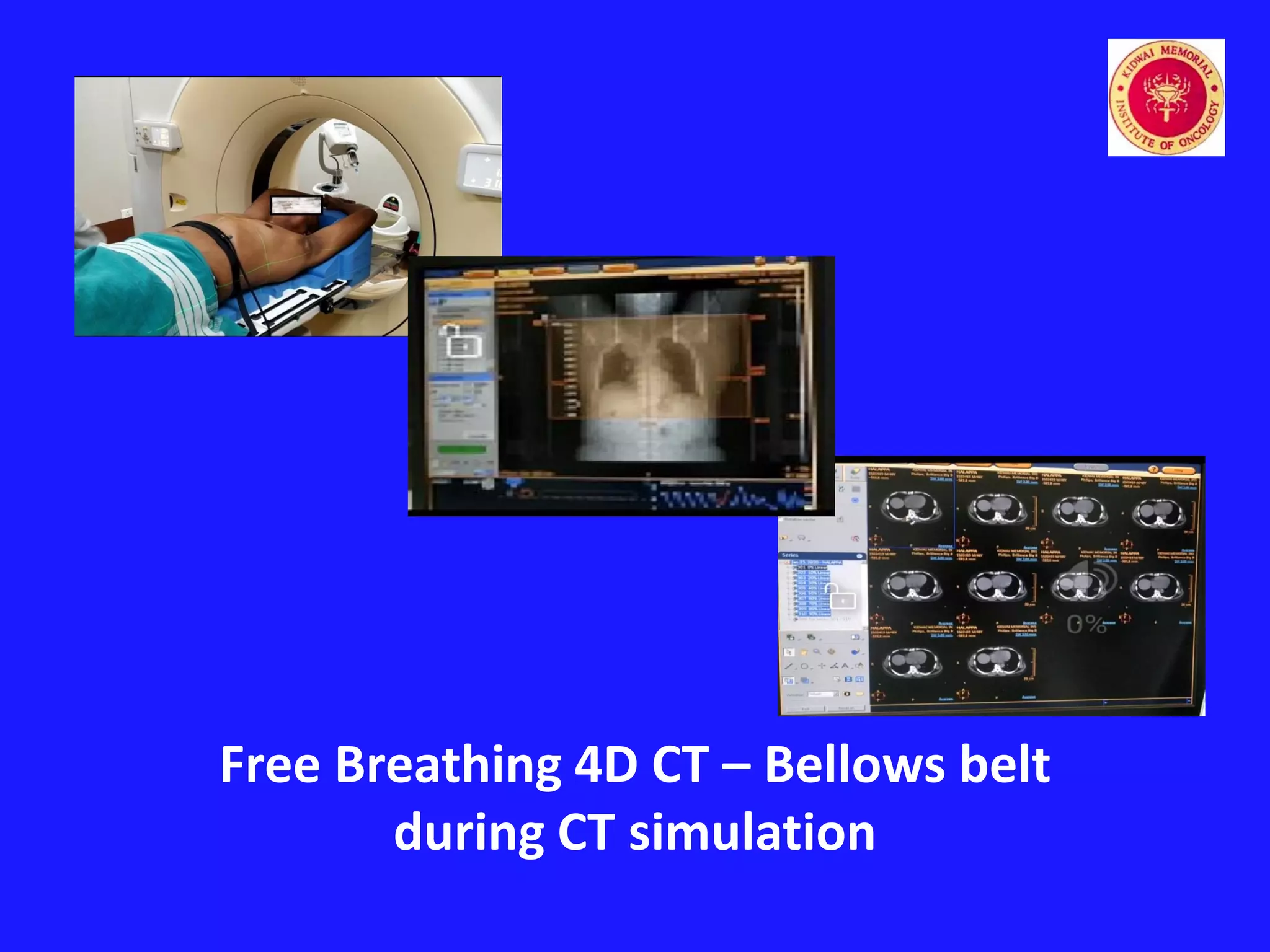 ABC system, Free Breath 4DCT & Symmetry Radiotherapy | PDF