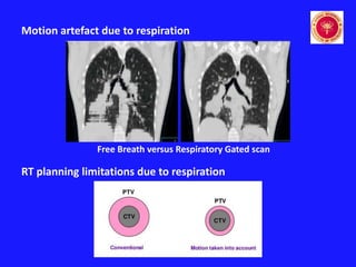ABC system, Free Breath 4DCT & Symmetry Radiotherapy | PDF