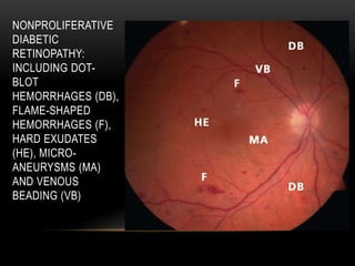 Dot And Blot Hemorrhages