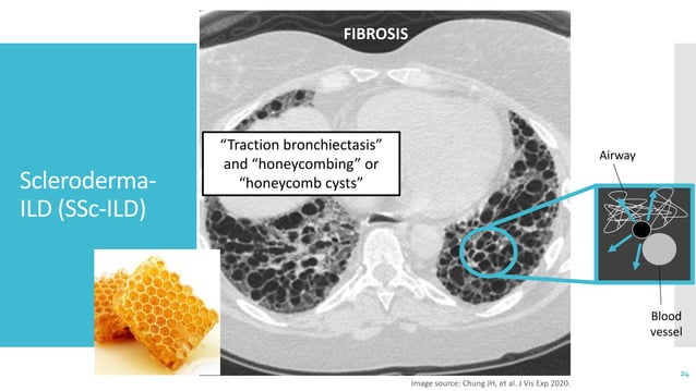 What you need to know about Scleroderma and Lung Disease - Dr. Selvan | PPT