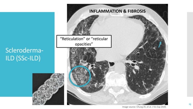 What you need to know about Scleroderma and Lung Disease - Dr. Selvan | PPT