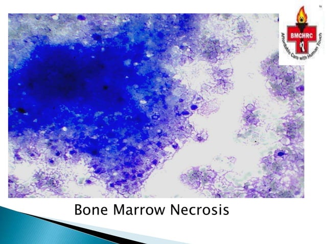Dr shashi bansal approch to bone marrow examination | PPT