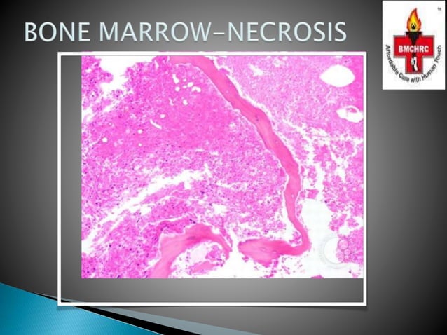 Dr shashi bansal approch to bone marrow examination | PPT