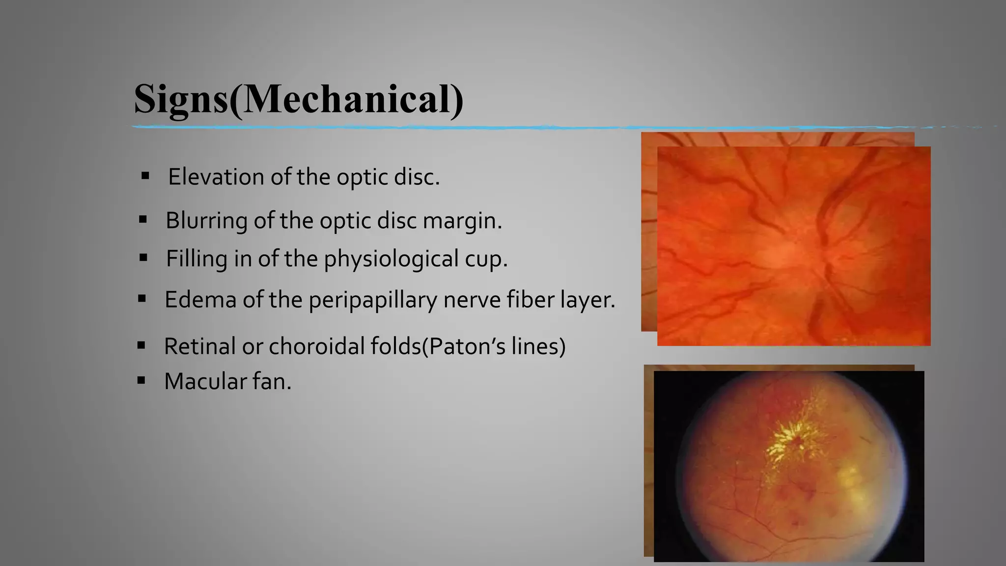 Papilledema - Dr Shylesh Dabke | PPTX